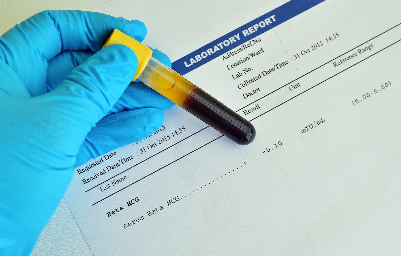 L’évolution du taux de Bêta HCG - 9moisetplus